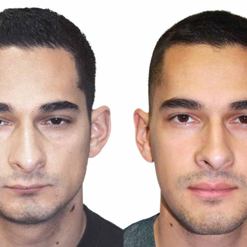 Upper, Lower Jaw, and Chin Forward - Orthognathic Surgery