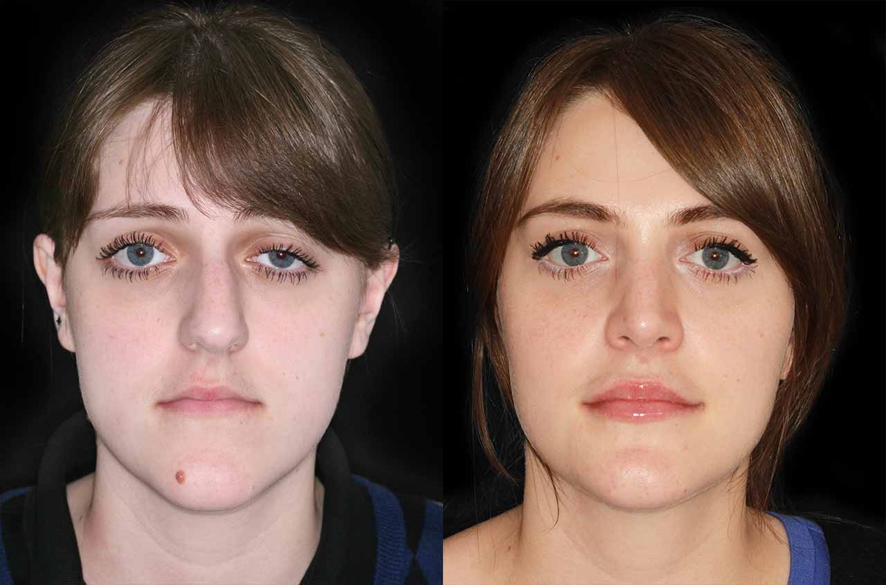 Contouring of the mandible, maxillary advancement - Orthognathic Surgery