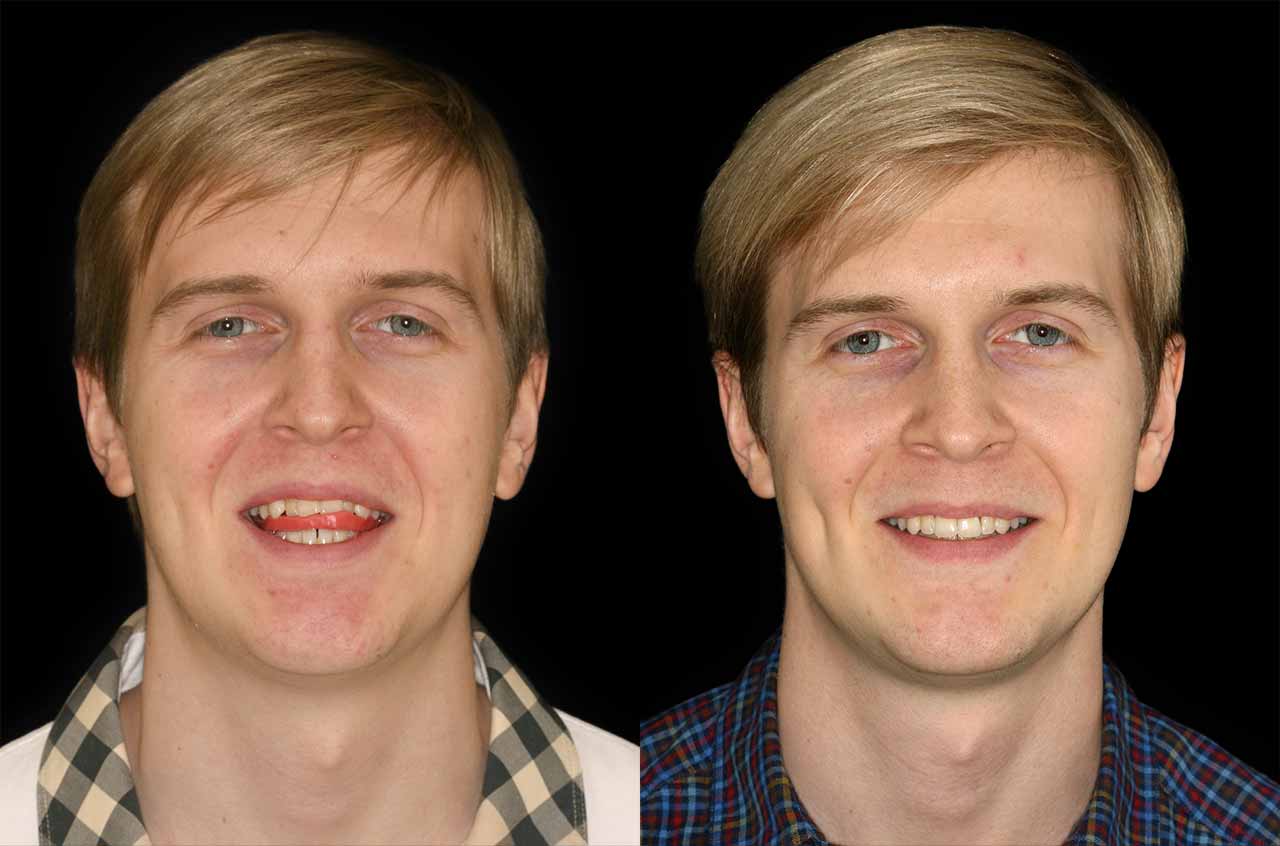 Face and Bite Correction - Orthognathic Surgery