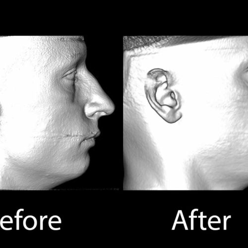 Face and Bite Correction Surgical Case - Orthognathic Surgery